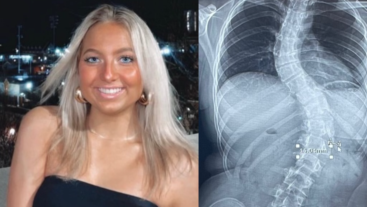 Fundraiser by Hanns Mercer : Help Hannah Heal: Support Her Scoliosis ...