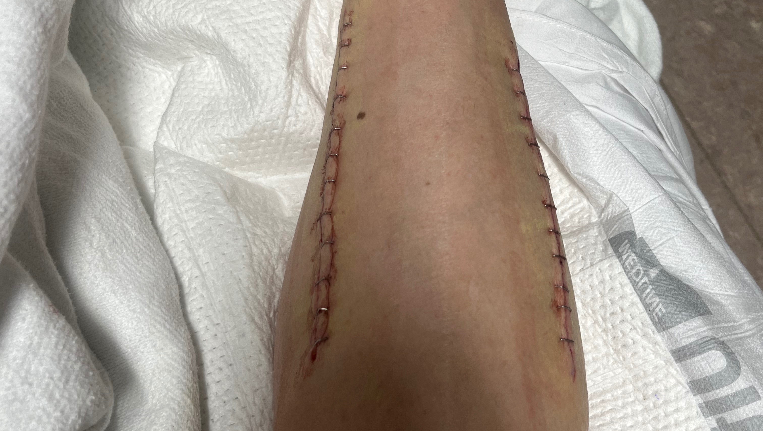 Fundraiser by Tracy Mallory : Aid Tracy's Fight Against Cancer and Clots