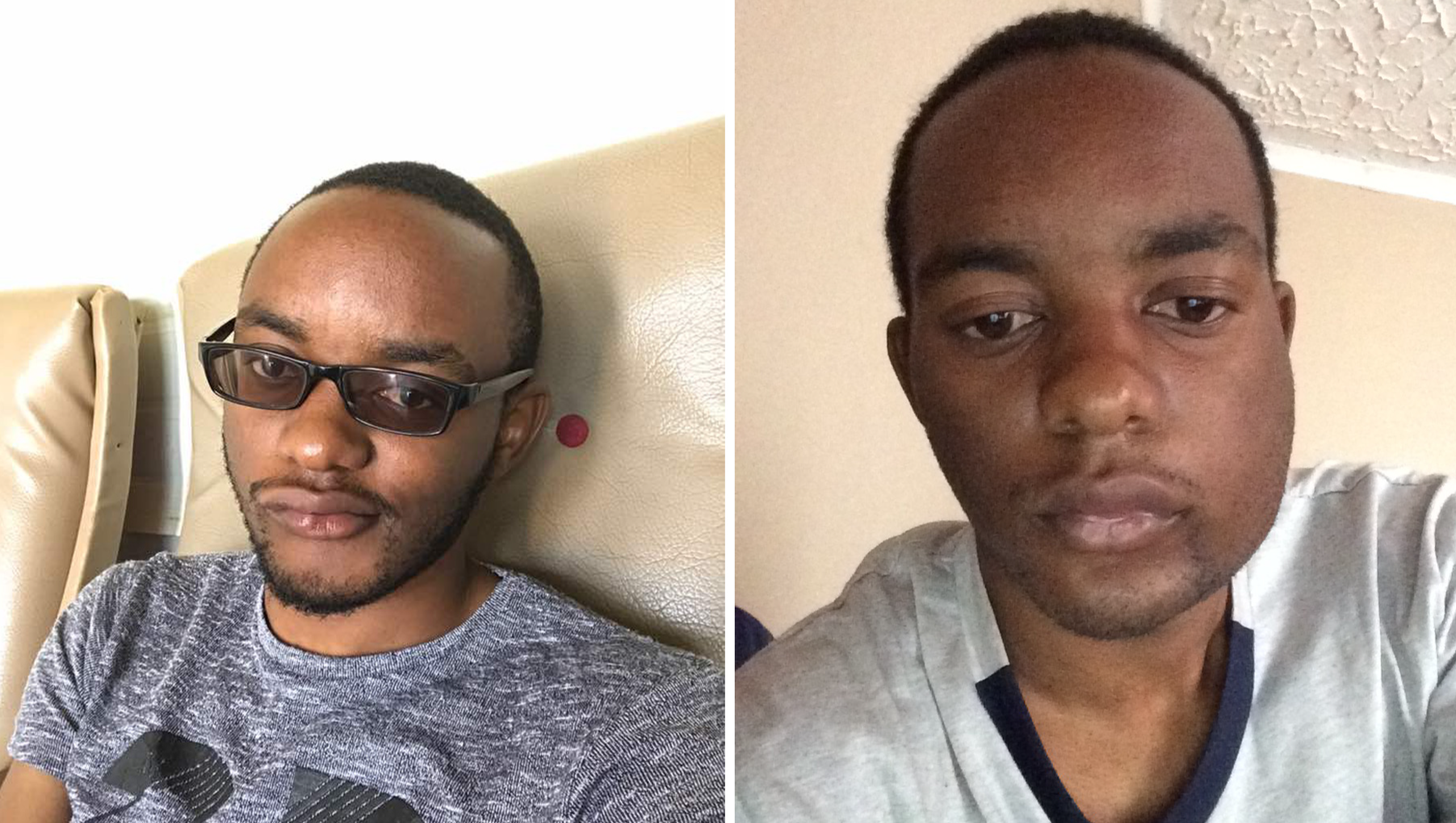 Fundraiser by Anesu Brian SIMANGO : Help my brother with Jaw Reconstruction Surgery