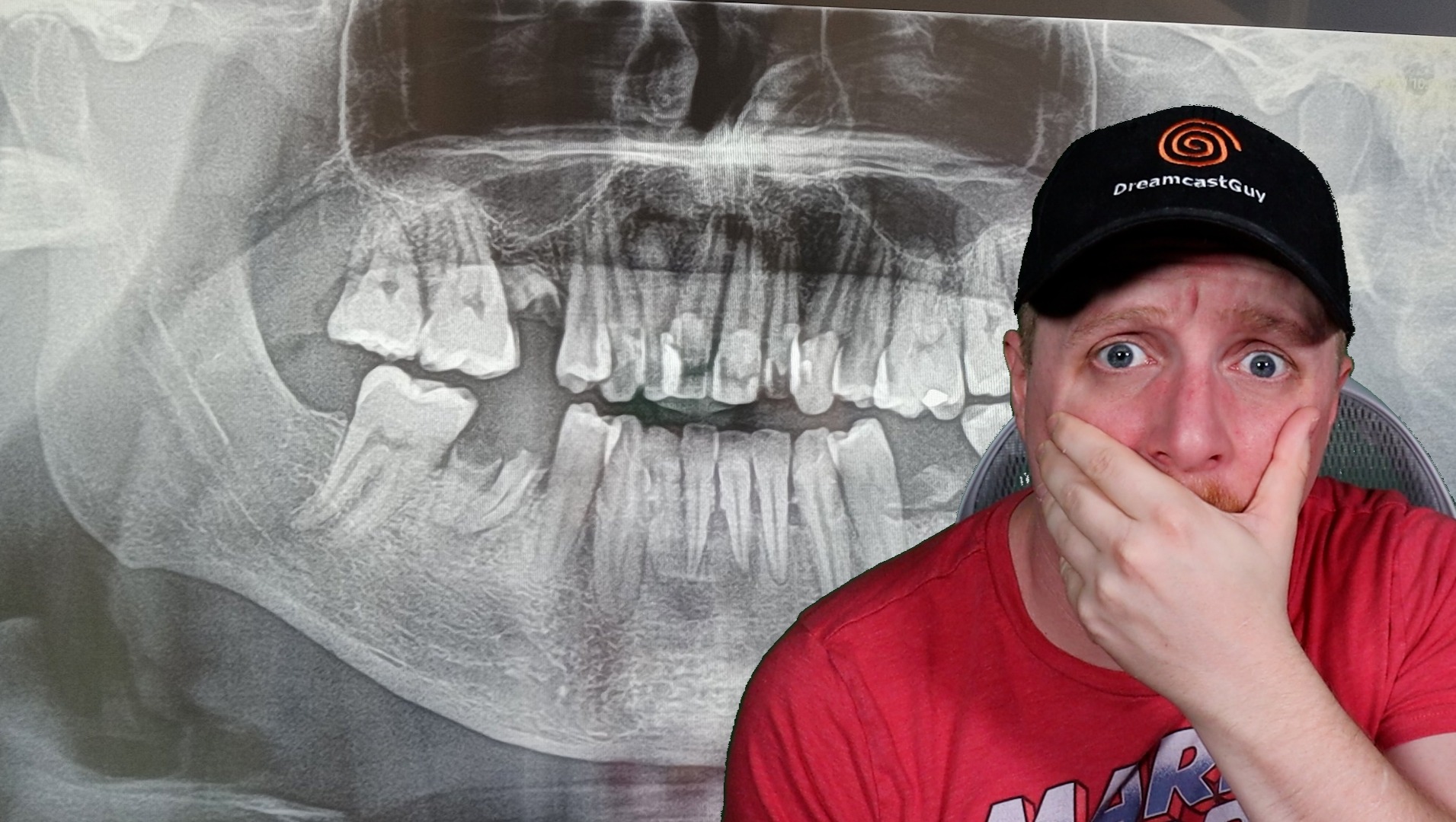 Fundraiser by Max Shockley : Help Max Fix his Broken Teeth!