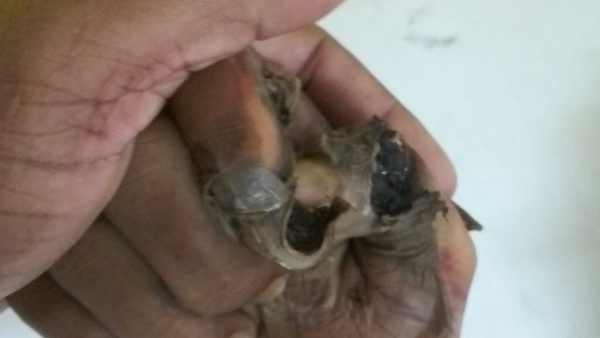 Fundraiser by William Singh : Rally for Chace: Prosthetics and Burn ...