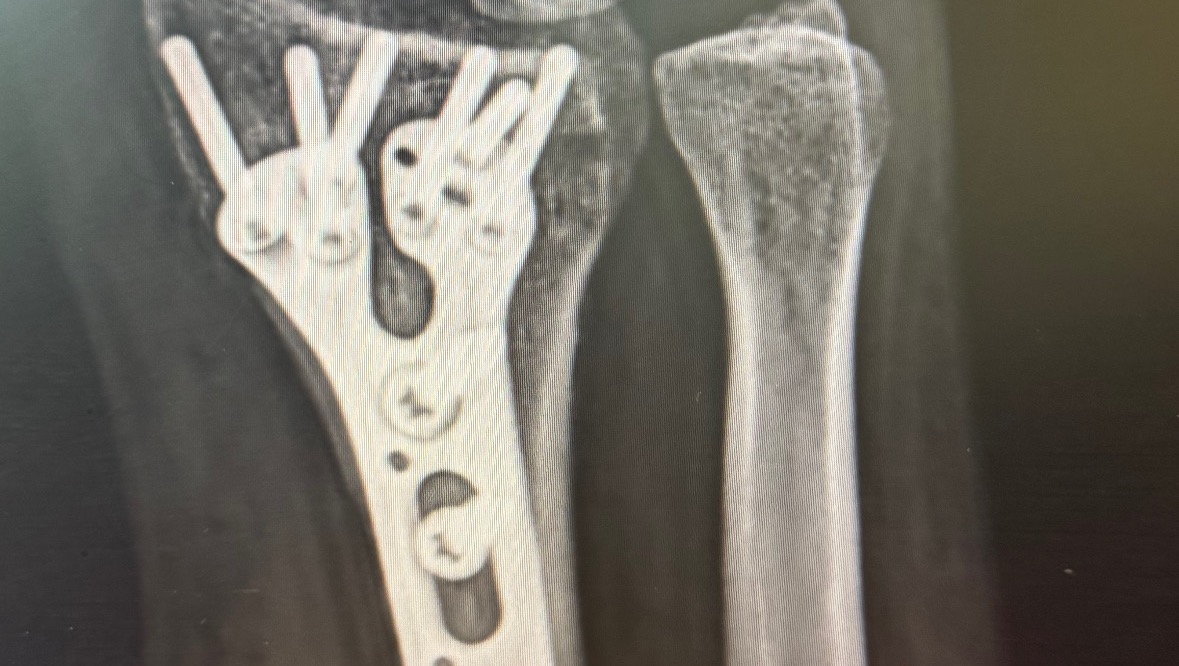 Fundraiser by Krista Lawhon : Lend a Hand to Krista's Recovery Fund