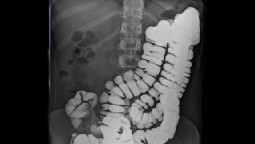 Fundraiser by Kristy Hopkins : Help Me Get Life-Changing Surgery for ...