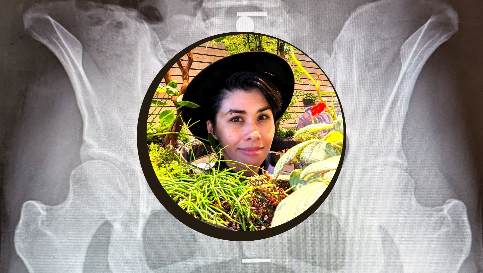 Fundraiser by Ellie Kirkner : Help Ellie Get Hip Surgery & a Wheelchair ...