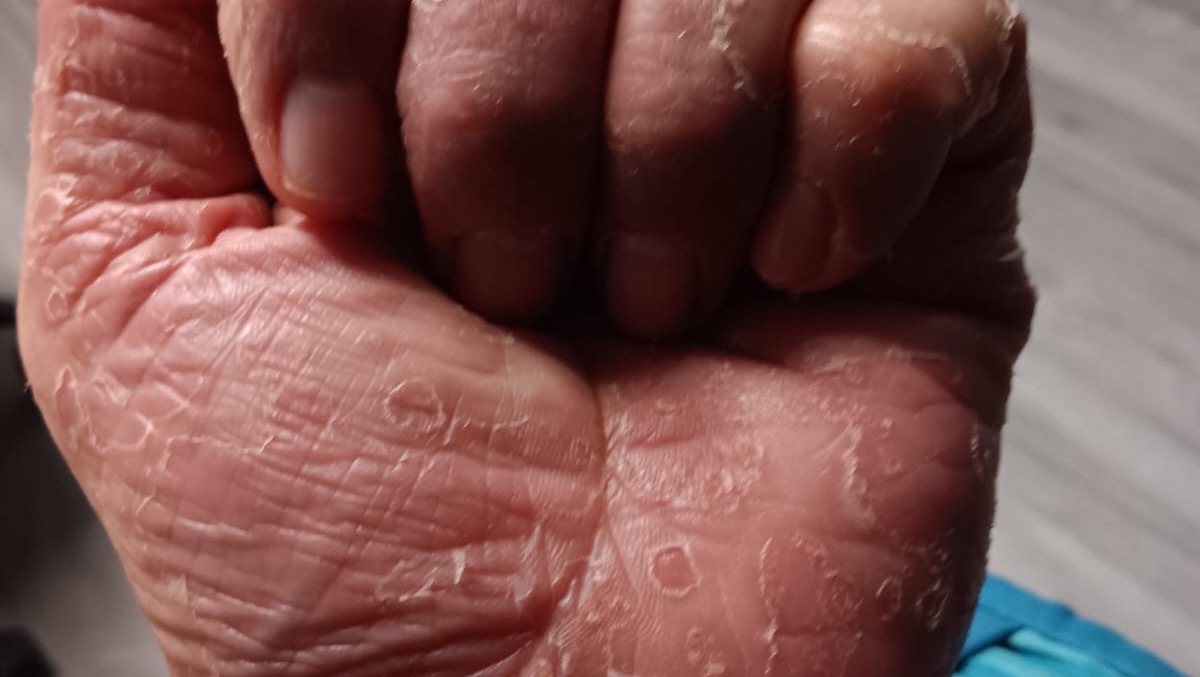 Fundraiser by Brianna Delgado : Support Victor's Fight Against Rare Skin Disease