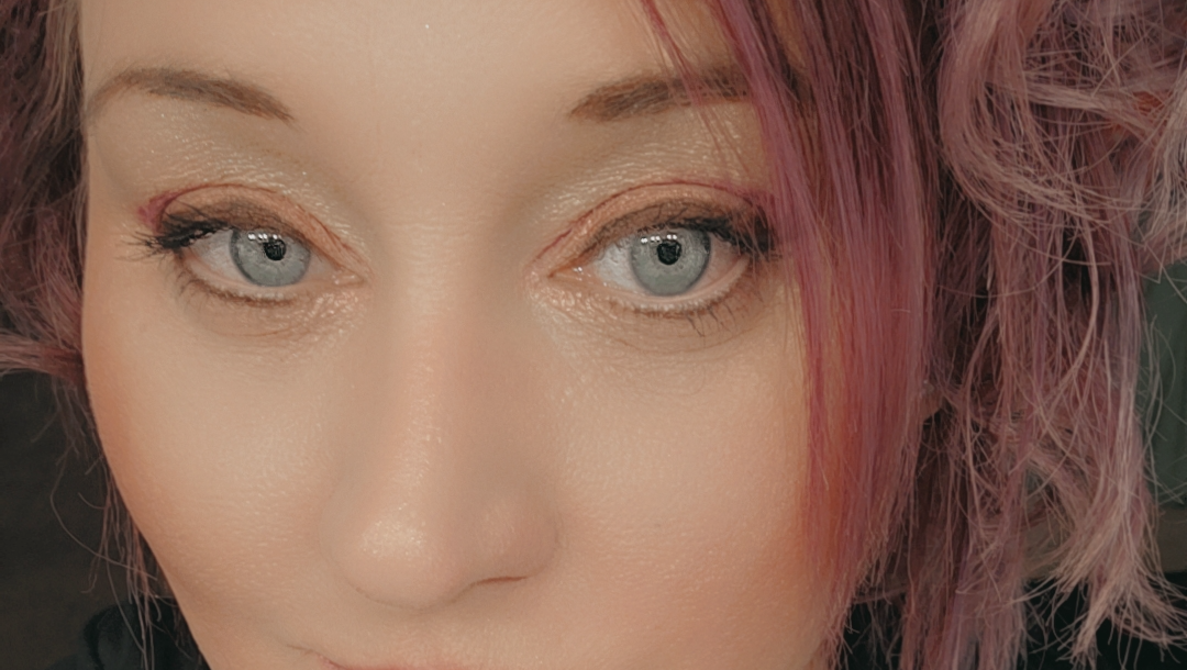 Fundraiser by April Seth : Help Save Vision: Support Keratoconus Surgery