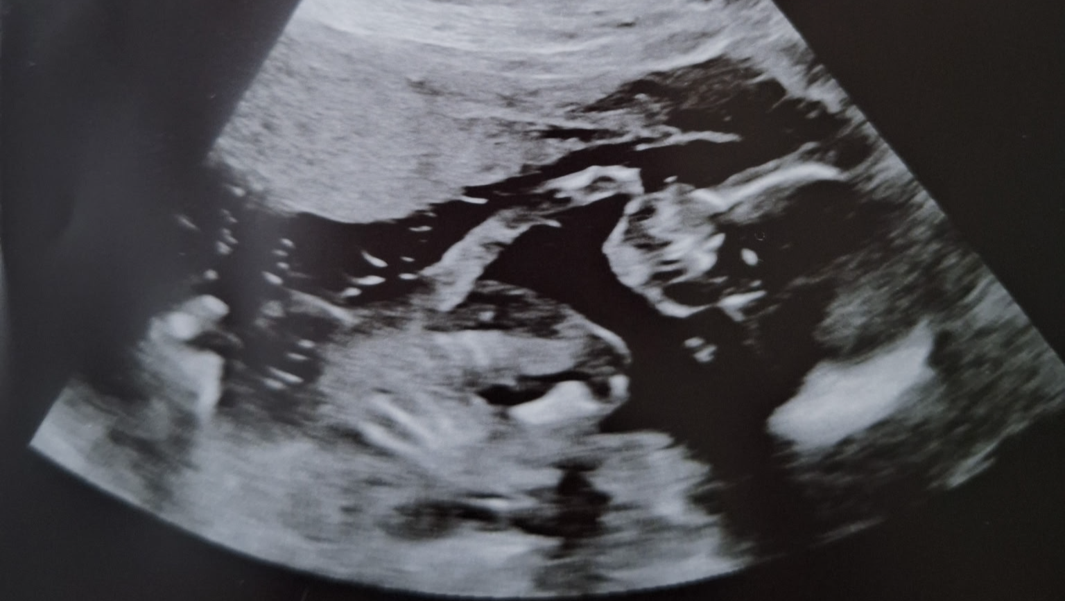 Fundraiser by Amanda Atkinson : Support Tim, Andrea, and Harper Jo ...