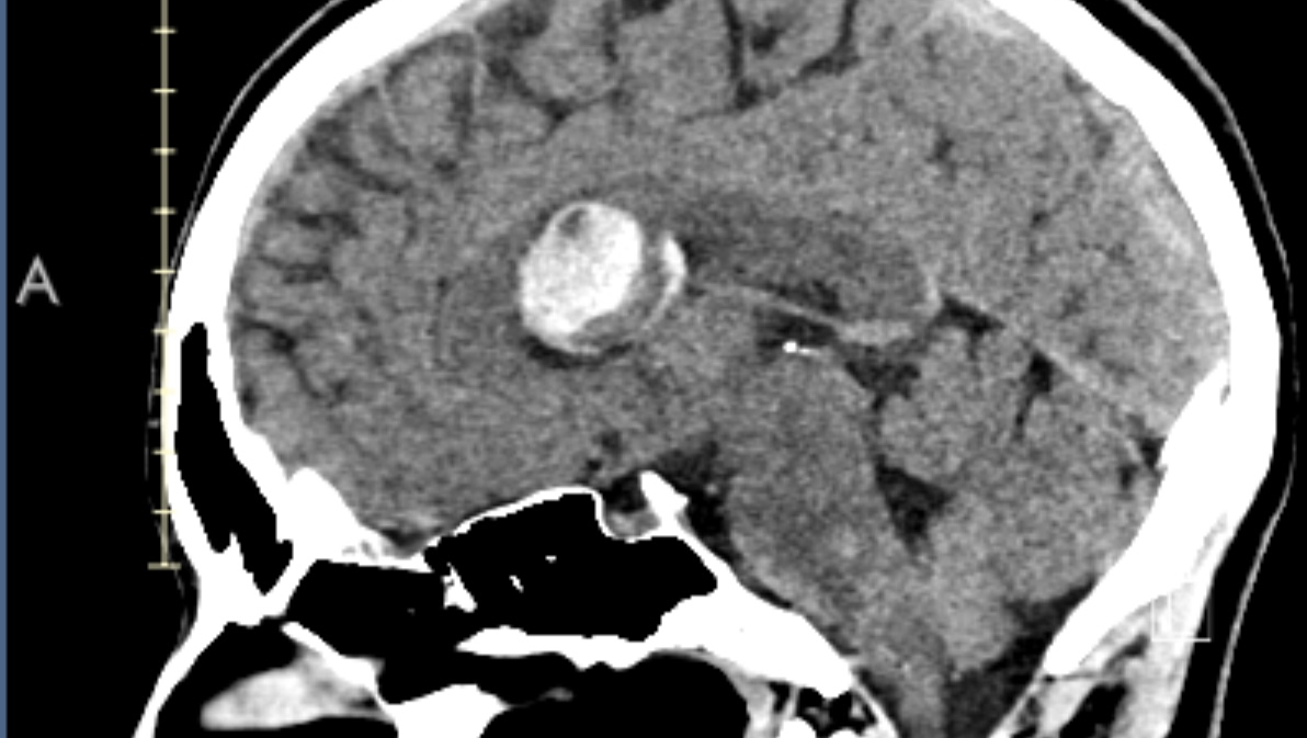 Fundraiser by Friends of Megan : Help Megan Hiler Through Surgery and ...