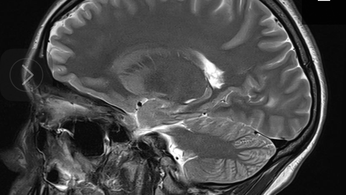 Fundraiser by Regan Boyce : Regan’s scoliosis supplies