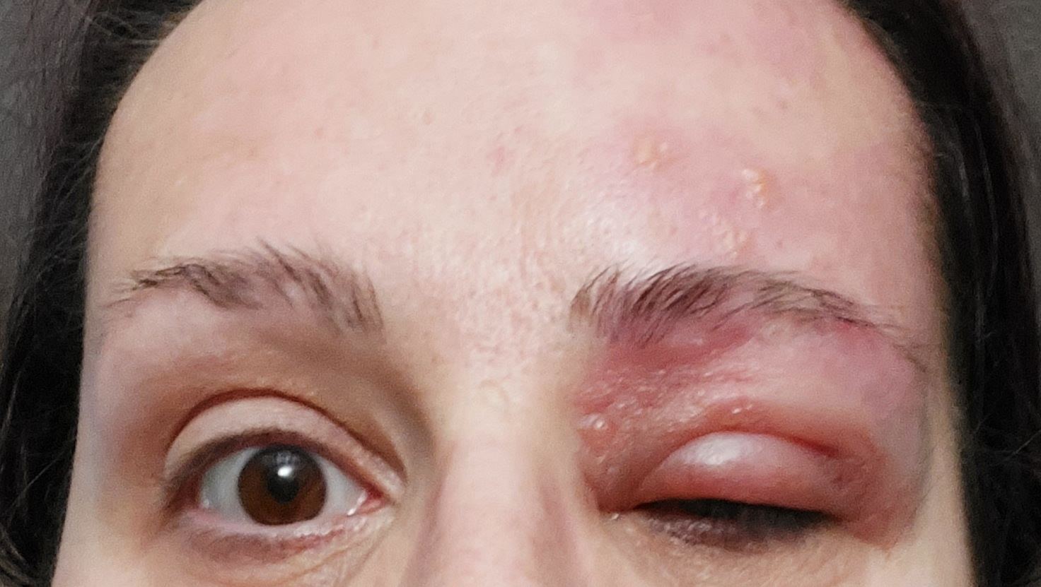 Fundraiser by Mindy Hunt : Support Mindy's Recovery and Healing from ...