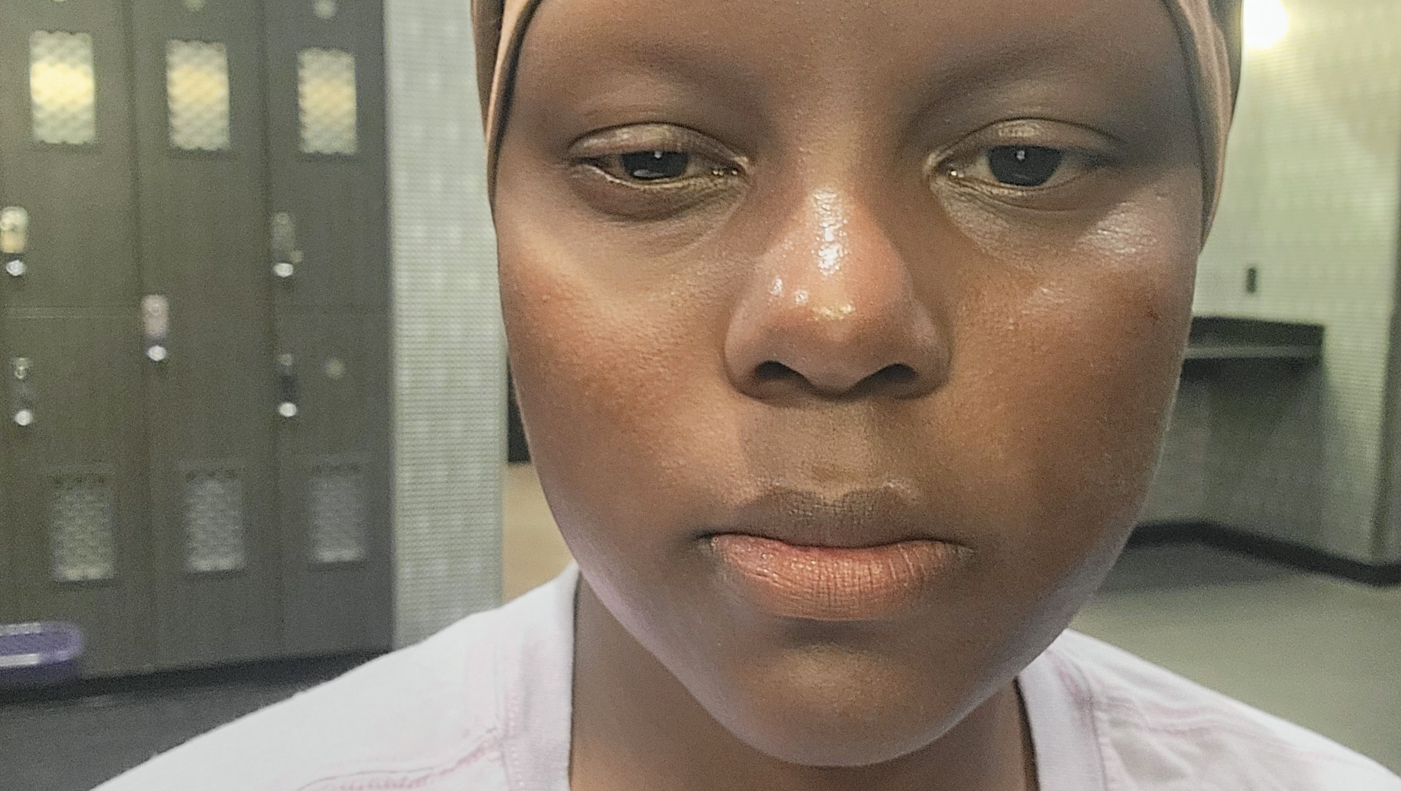 Fundraiser by Jewkaster Rowe : Support Needed for IIH Surgery Premium