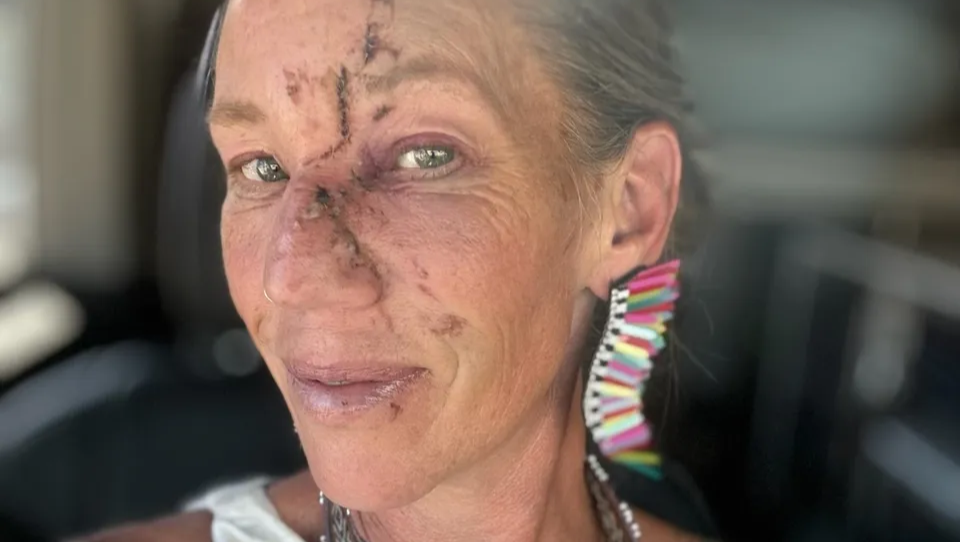 Fundraiser for Kathy Stanley by Phoenix Stanley : Support Surgery for ...