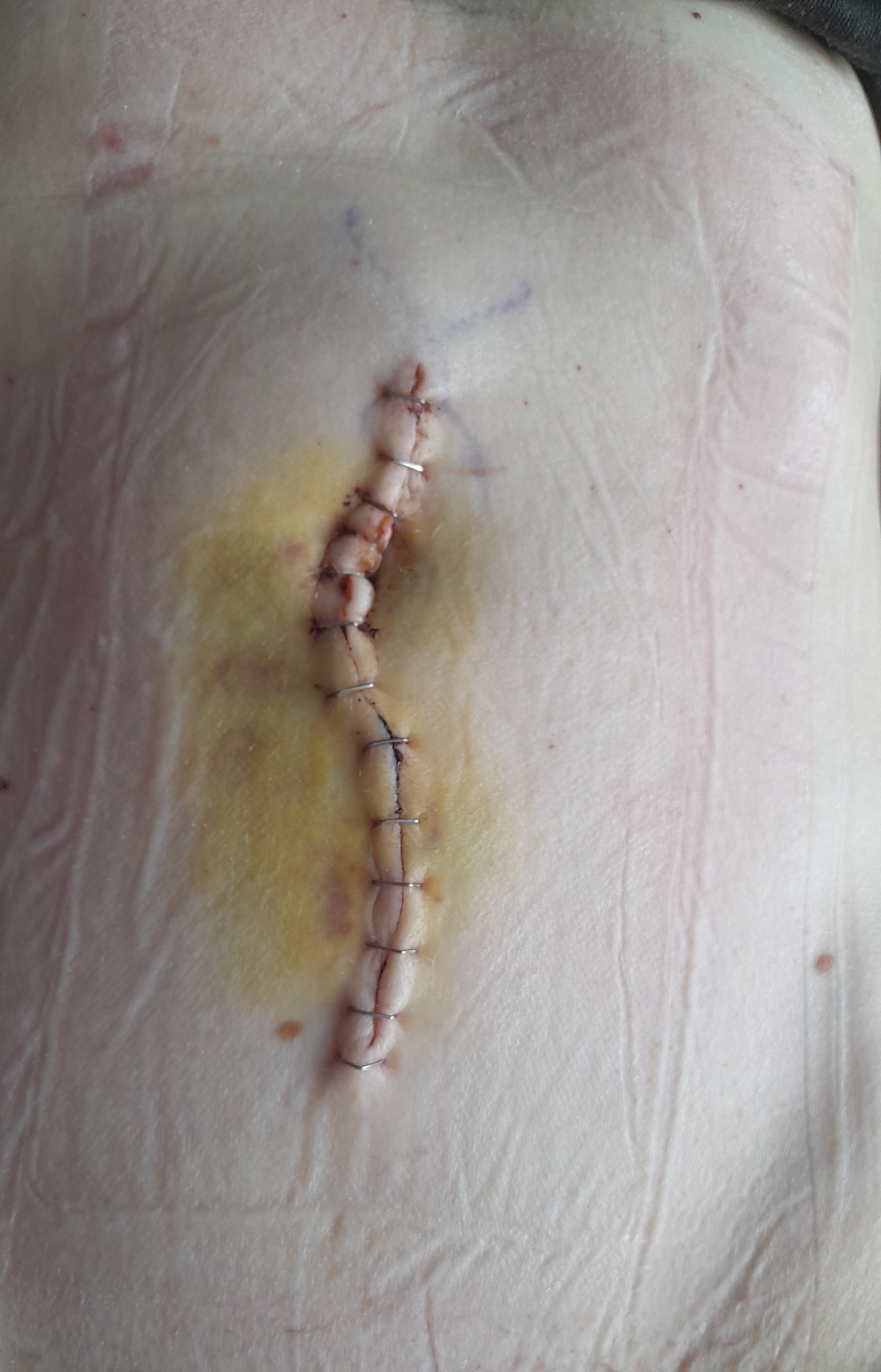 Fundraiser by Silke Herzer : Krebs nimmt dir alles.