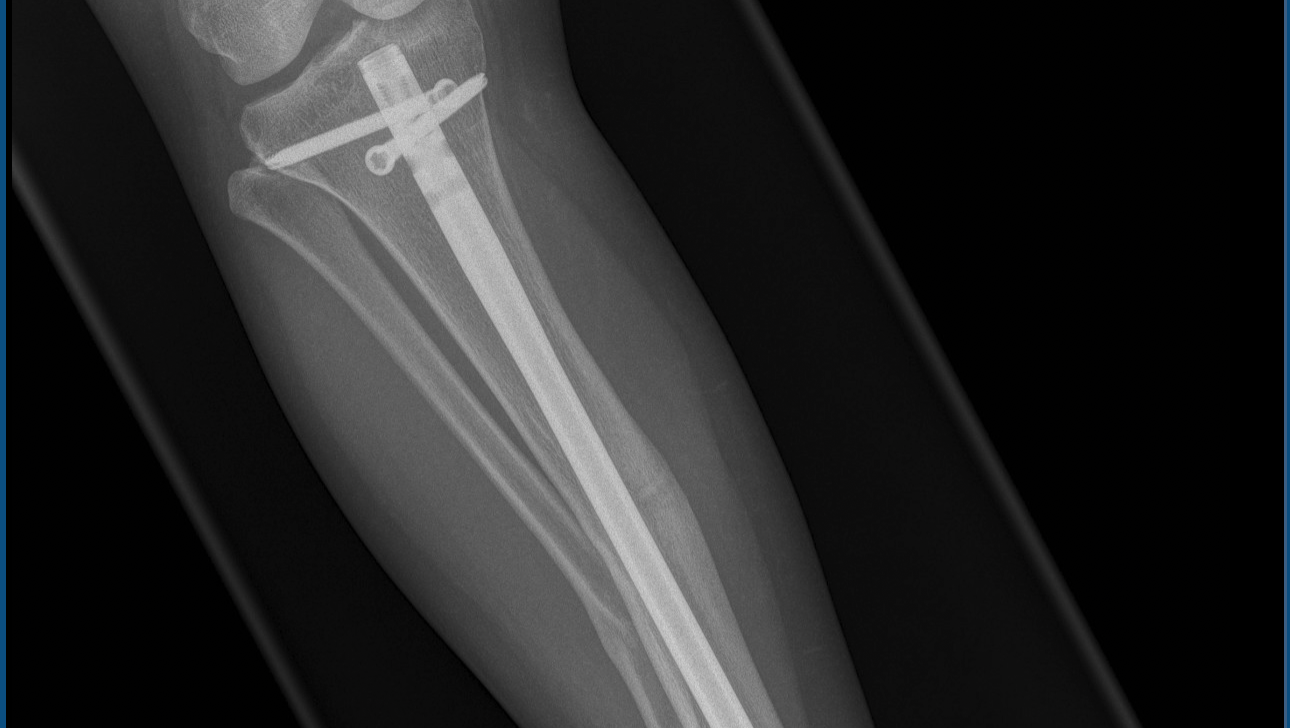 Fundraiser by Breanna Wilson : Urgent: Surgery for Protruding Leg Pins