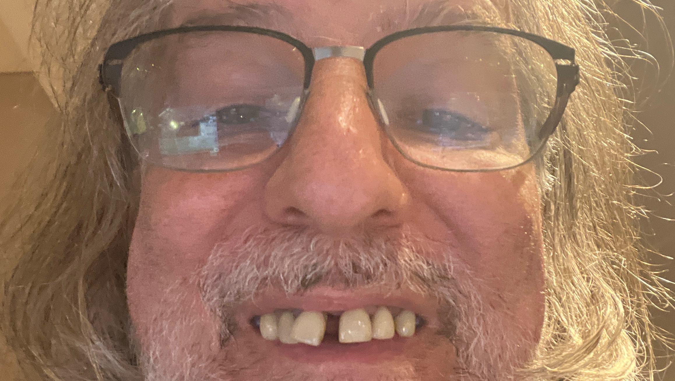 Fundraiser by Steve Shapiro : HELP SHAPI FIX HIS TEETH!!!