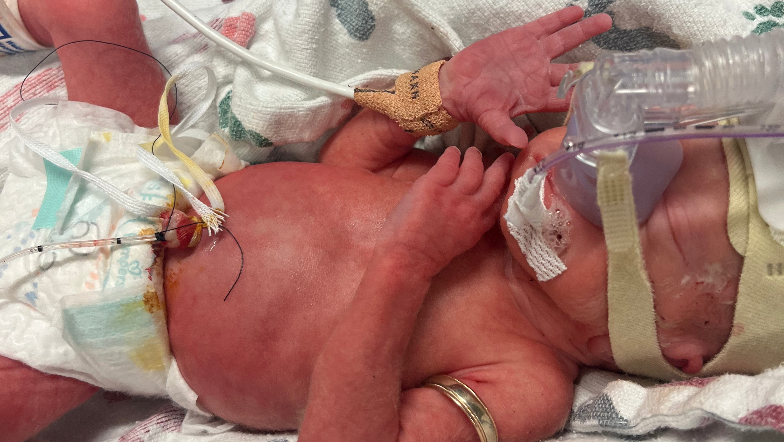 Fundraiser for Katie Foote by Diane cloer : Baby Adeline and the Foote ...