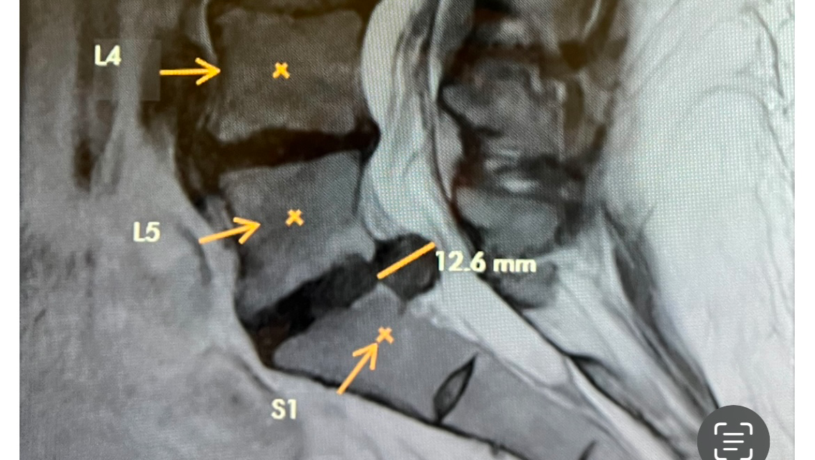 Fundraiser by Darci Gabriel : Support Darci's Spinal Surgery Recovery