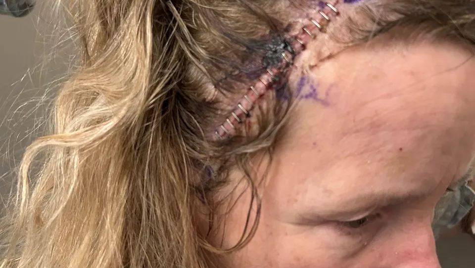 Fundraiser by Susan Aldridge : Support Susan’s Brain Cancer Fight