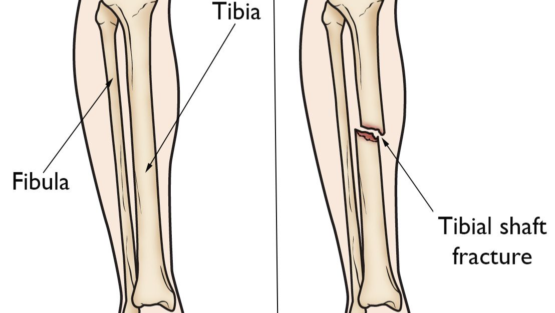 Fundraiser for Jonathon Cornett by Madison Cornett : Support Jon's ...