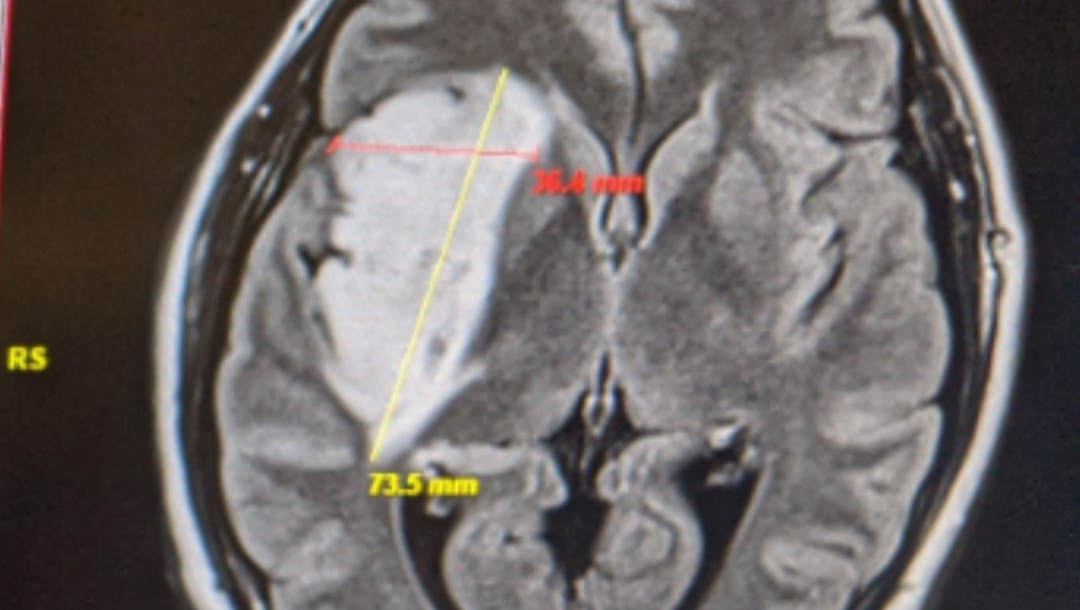 Fundraiser by Nicholas Hasz : Help Nick Hasz Keep His Home after Brain ...