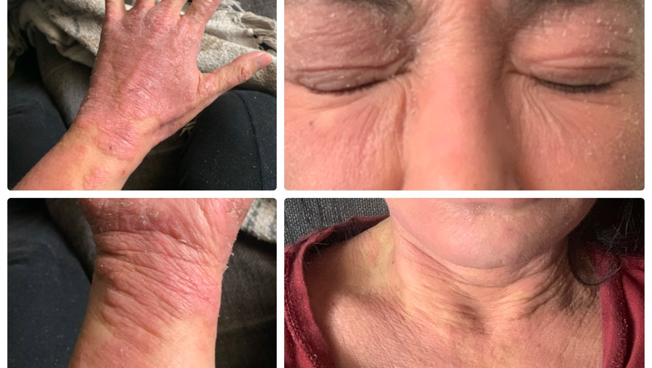 Fundraiser by Sita Syl : Heling TSW Sita met CAP-laser machine