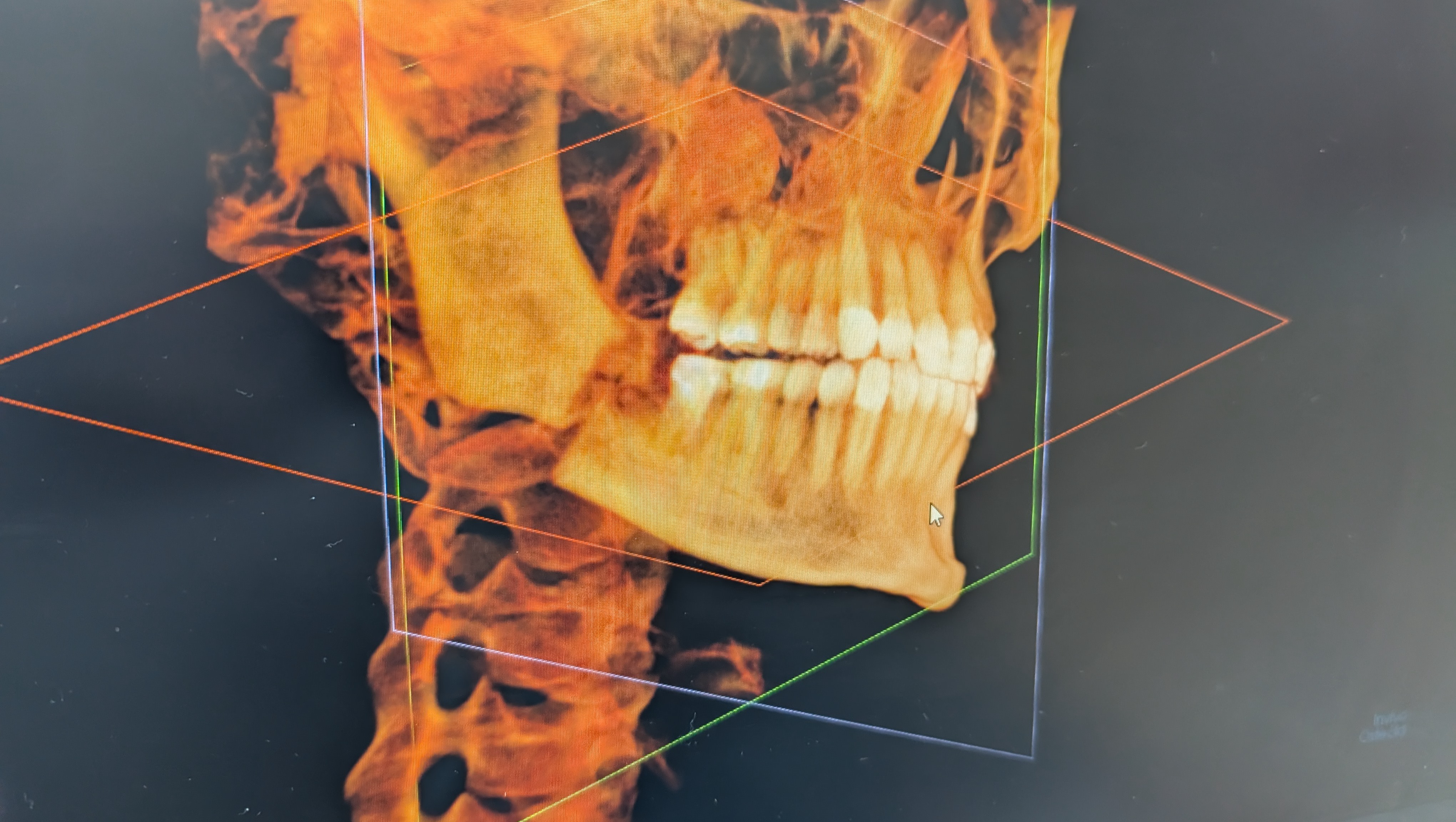 Fundraiser by Ian Bushell : Urgent Aid for Skylar's Jaw Surgery and Care