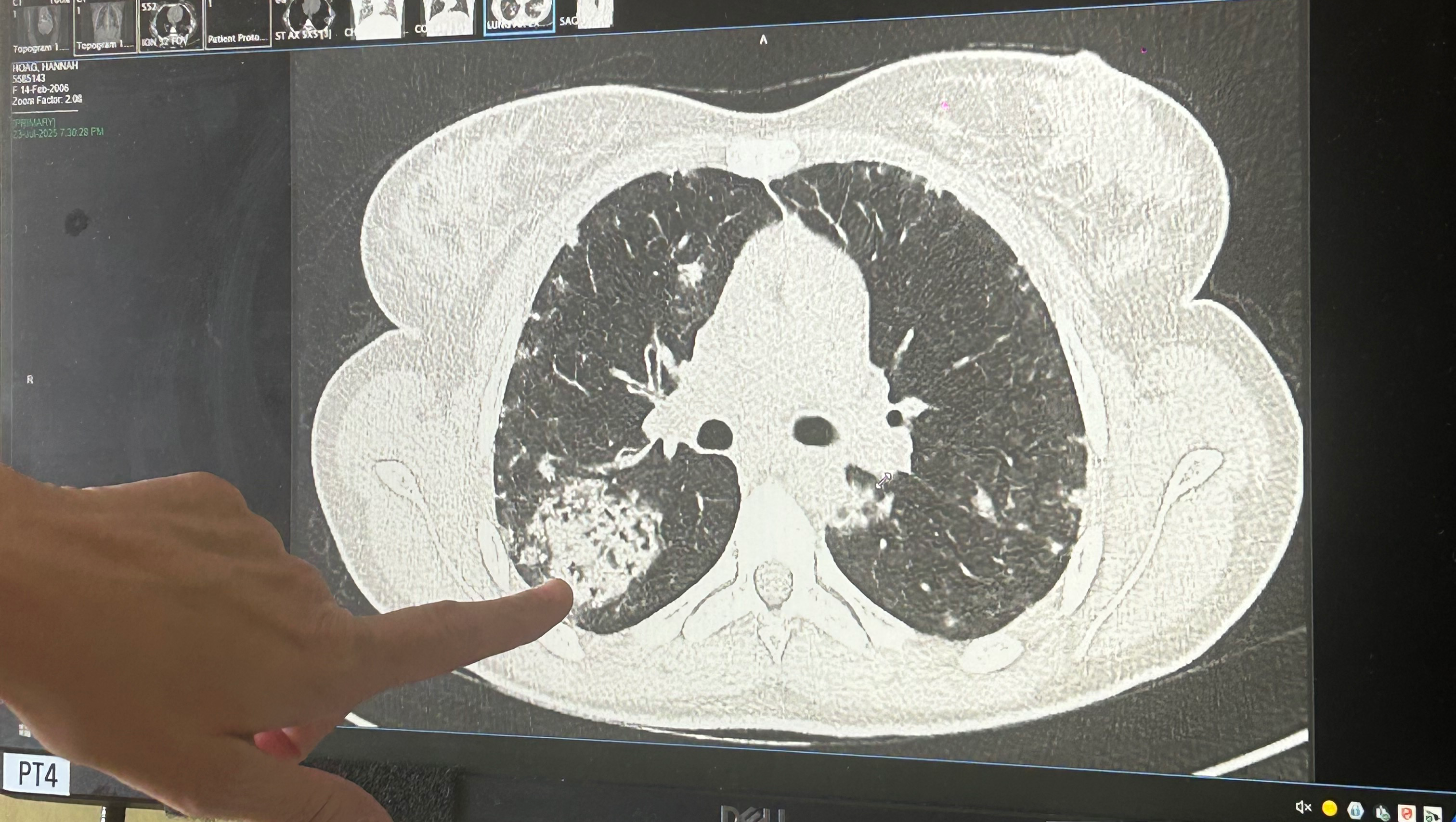 Fundraiser by Hannah Hoag : Help Hannah Hoag Get Life-Saving Treatment