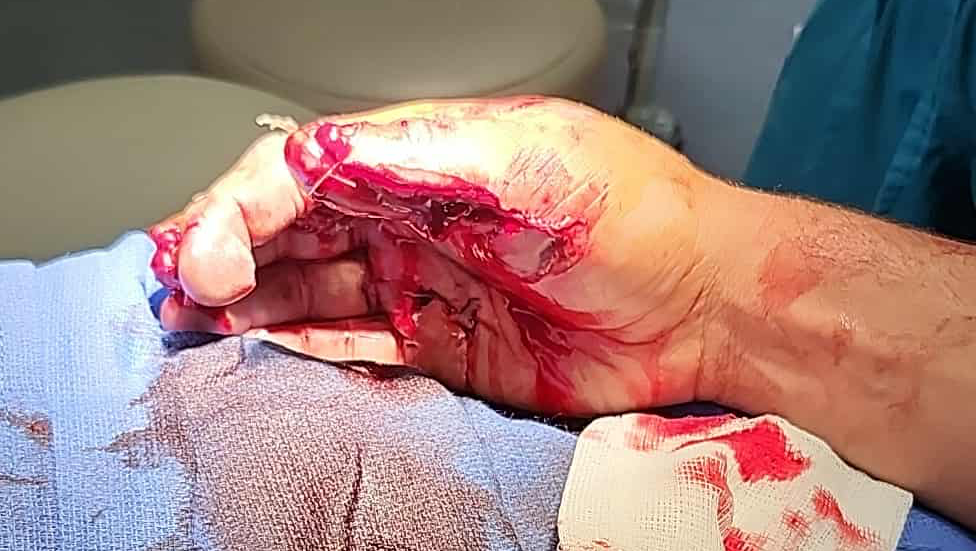 Fundraiser by Caitlin Kent : Help Caleb Recover from Severe Hand Injury