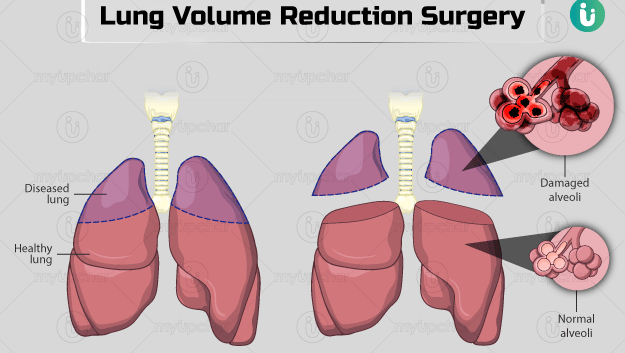 Fundraiser by Jamal Crews-Williams : Lung Repair-Lung Replacement