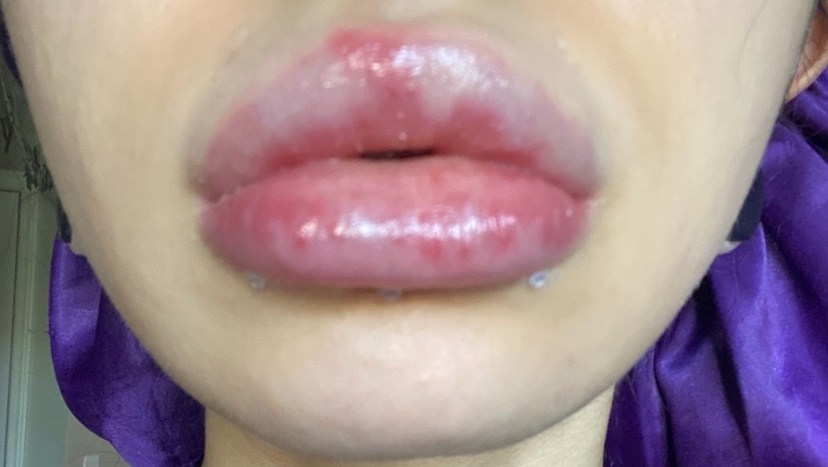 Fundraiser by Morgue Horde : Support Recovery from Traumatic Lip Filler ...