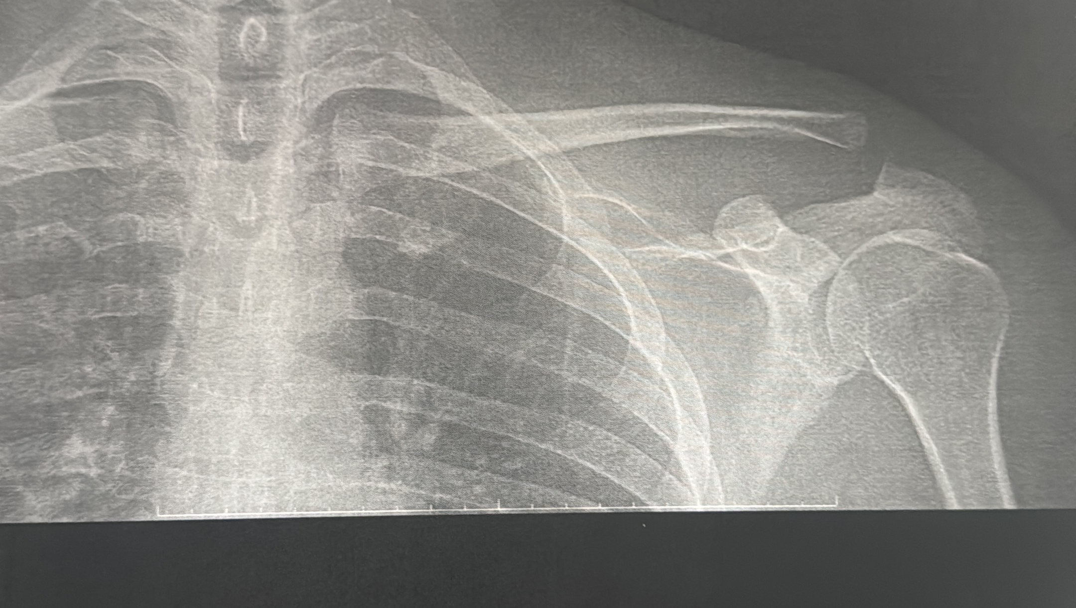 Fundraiser by Irwing Morales : Superior subluxation of the distal ...