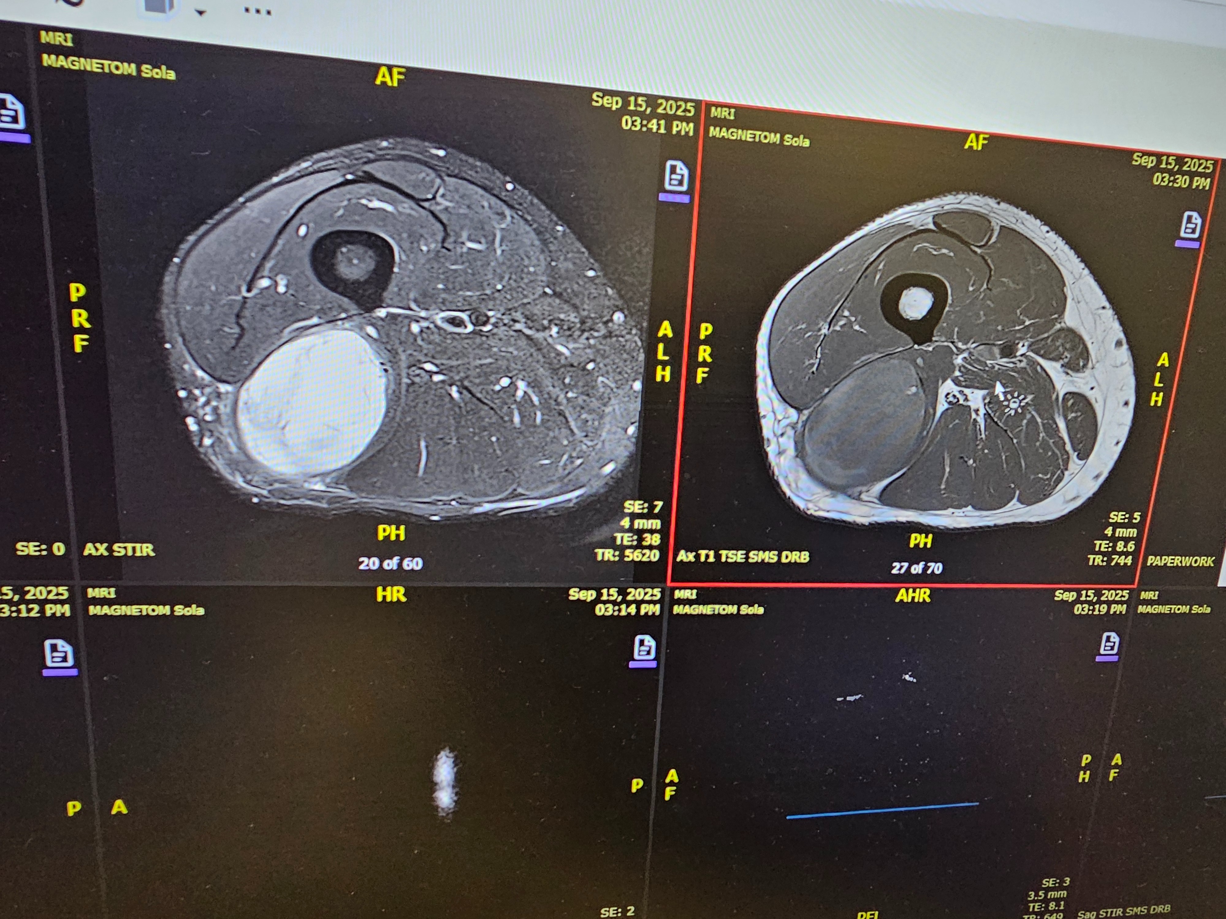 Fundraiser by Lori Owen : Donate to help Gerard with radiation, cancer ...