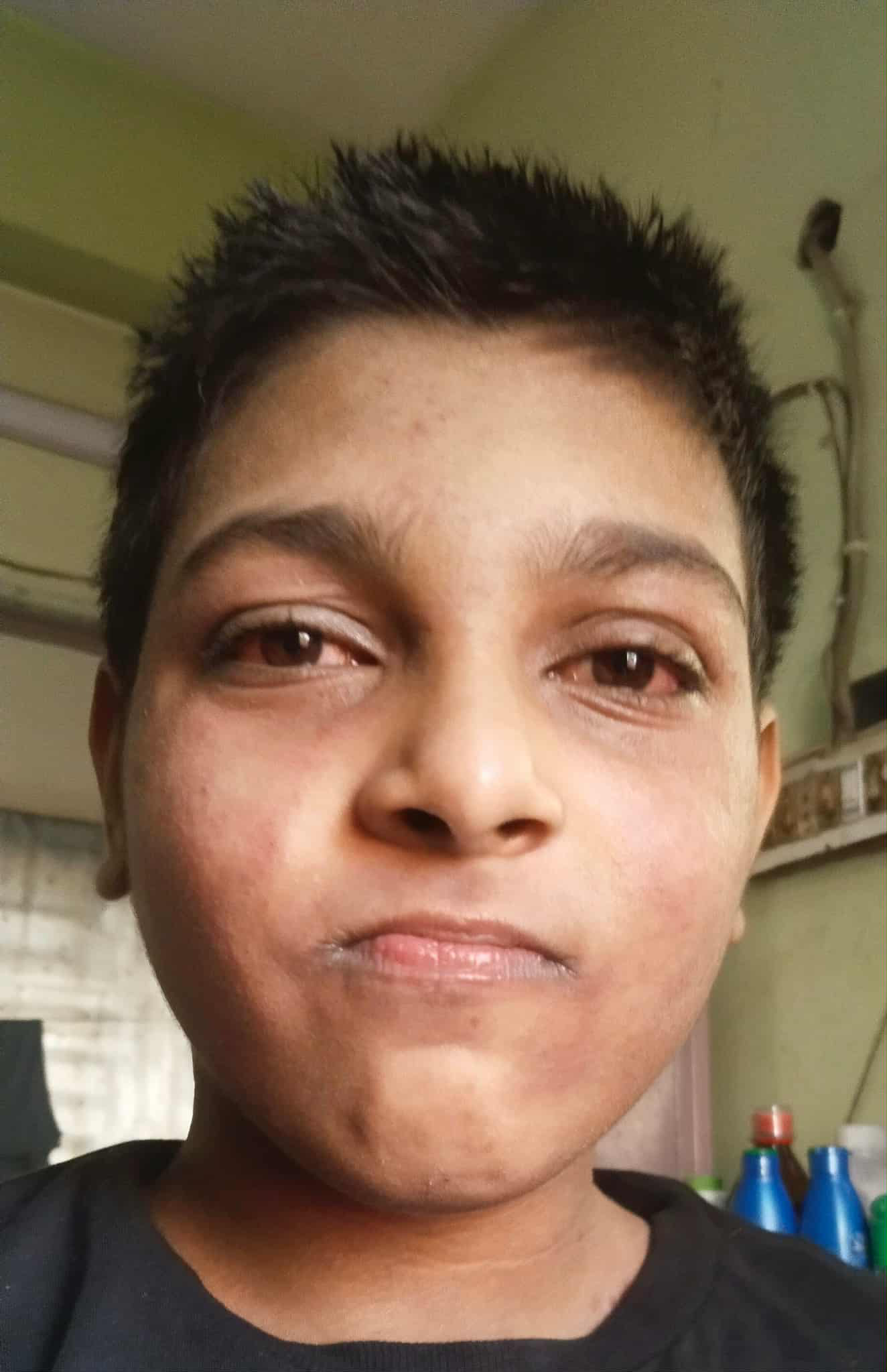 Fundraiser by Ashish Kumar Kuri : Help 13-year-old Zayan for Life ...