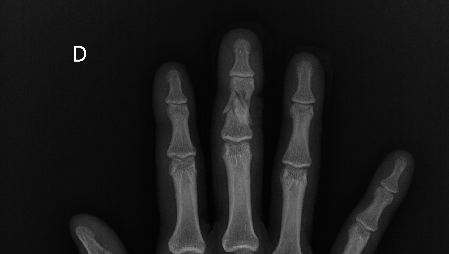 Fundraiser for Sebastian Hidalgo by Ruth Puchoc : Graft Bone-tendon ...