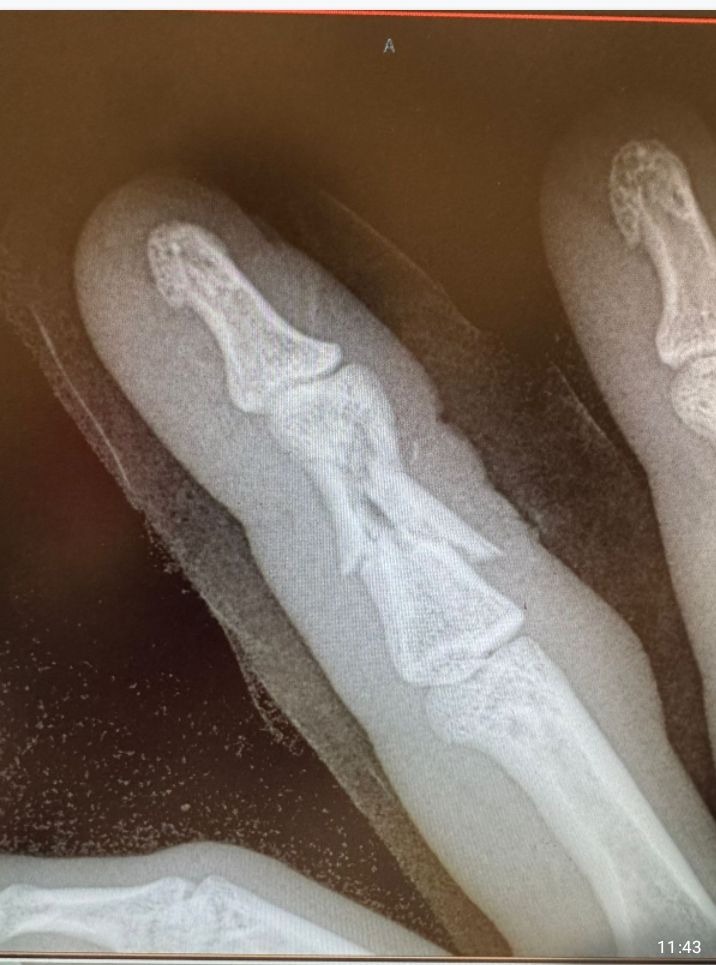 Fundraiser for Sebastian Hidalgo by Ruth Puchoc : Graft Bone-tendon ...