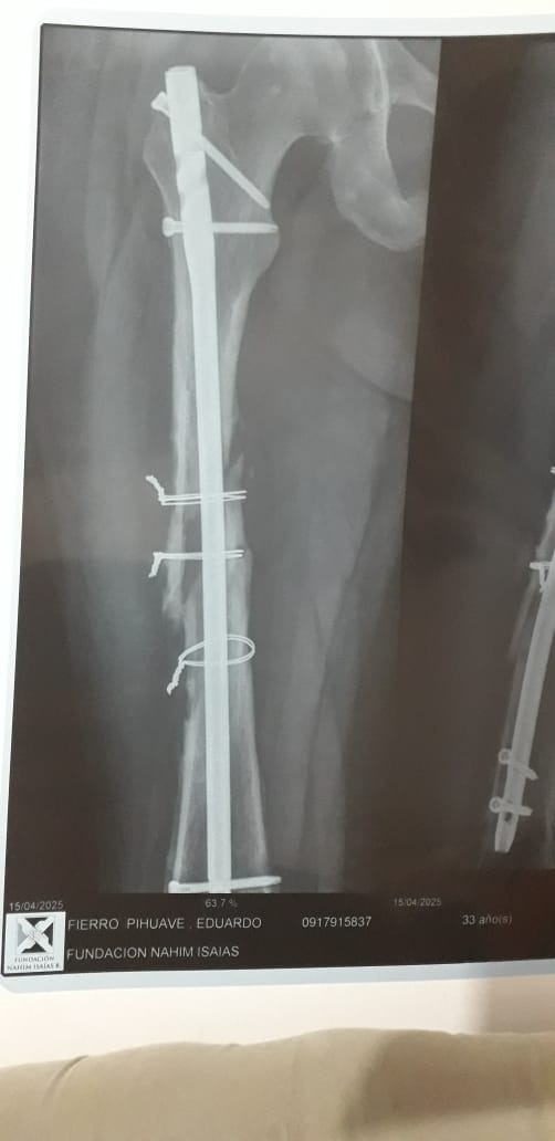 Fundraiser by Violet Mateo : Eduardo Fierro Needs $6,000 for Femur ...