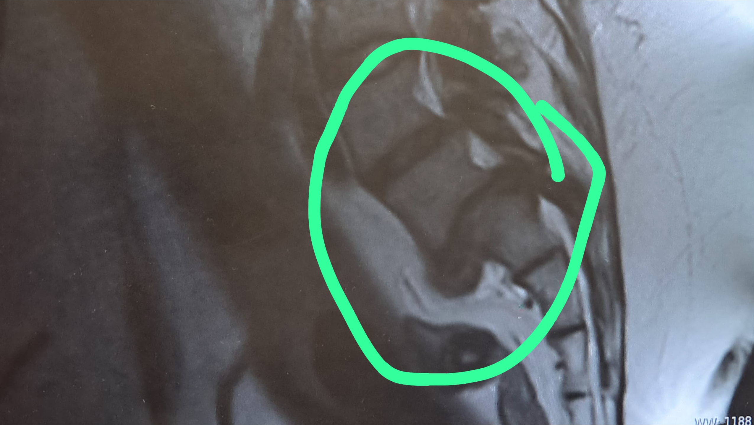 Fundraiser by Jenny and : Support for Back Surgery medical bills