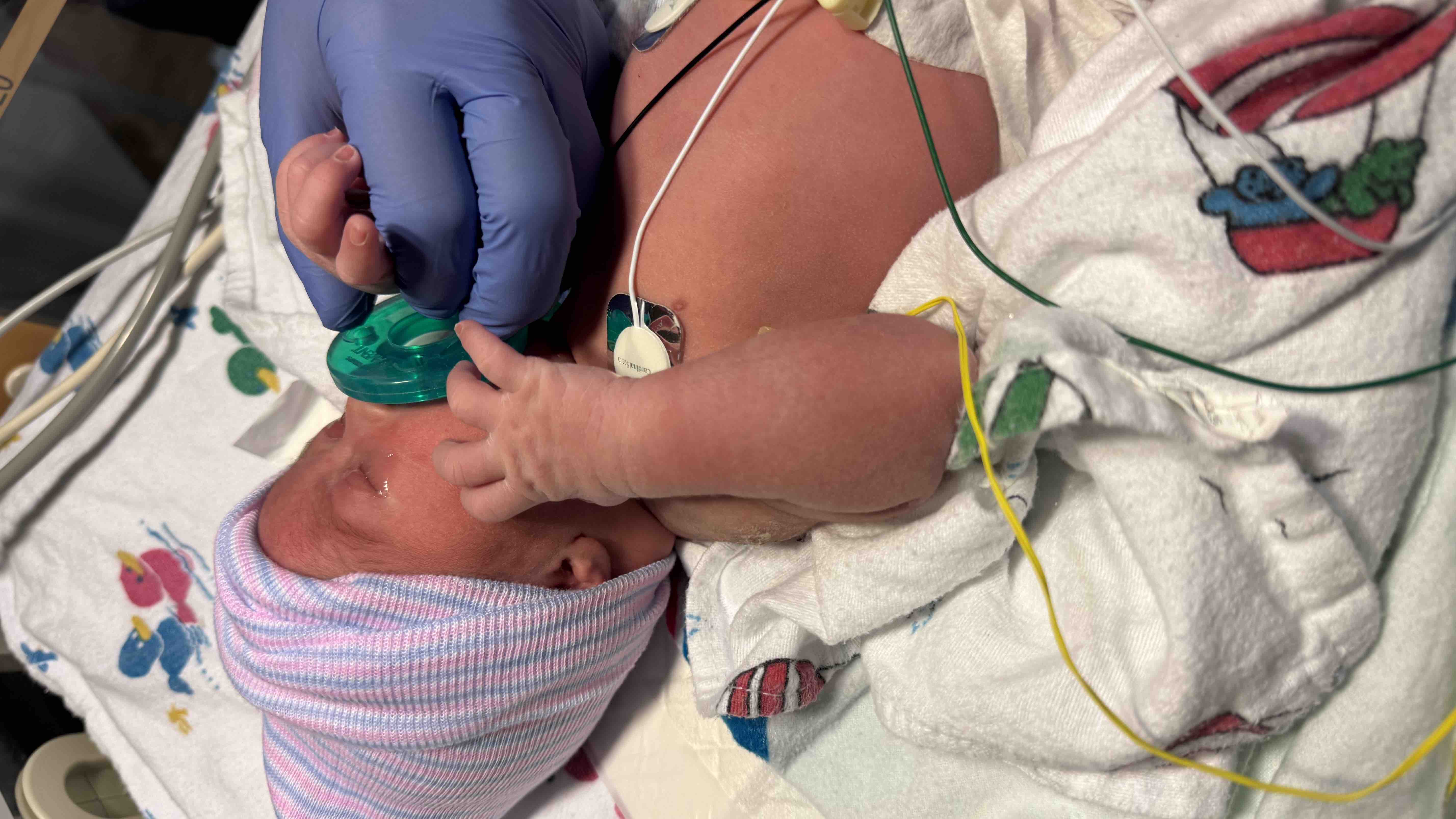 Fundraiser by Eleana Livingston : Support for Baby Ace's Surgery and ...