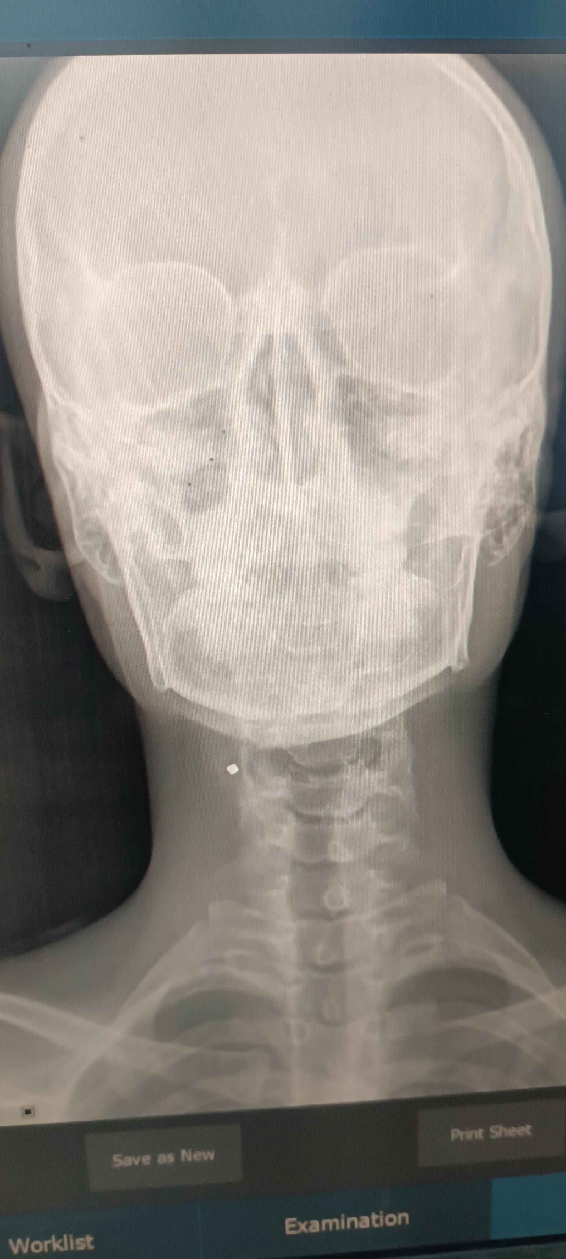 Fundraiser by Amer Meqdad : My Body Is Full of Shrapnel… But I'm Still ...