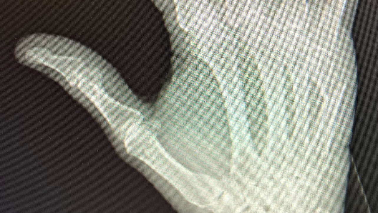 Fundraiser by Matt King : Matt’s Hand Surgery