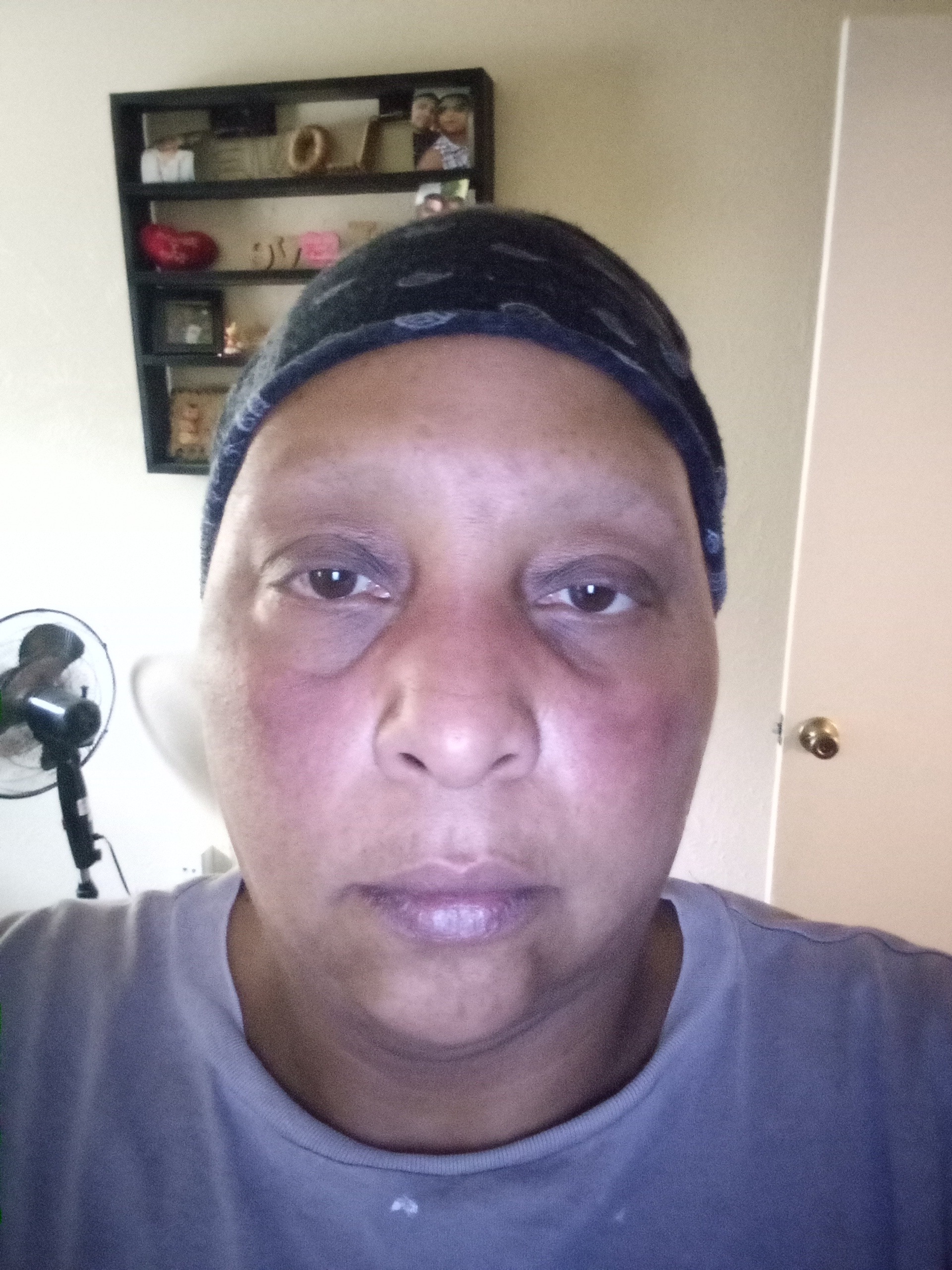 Fundraiser by Barbara Villa : need help with treatment and bill please help