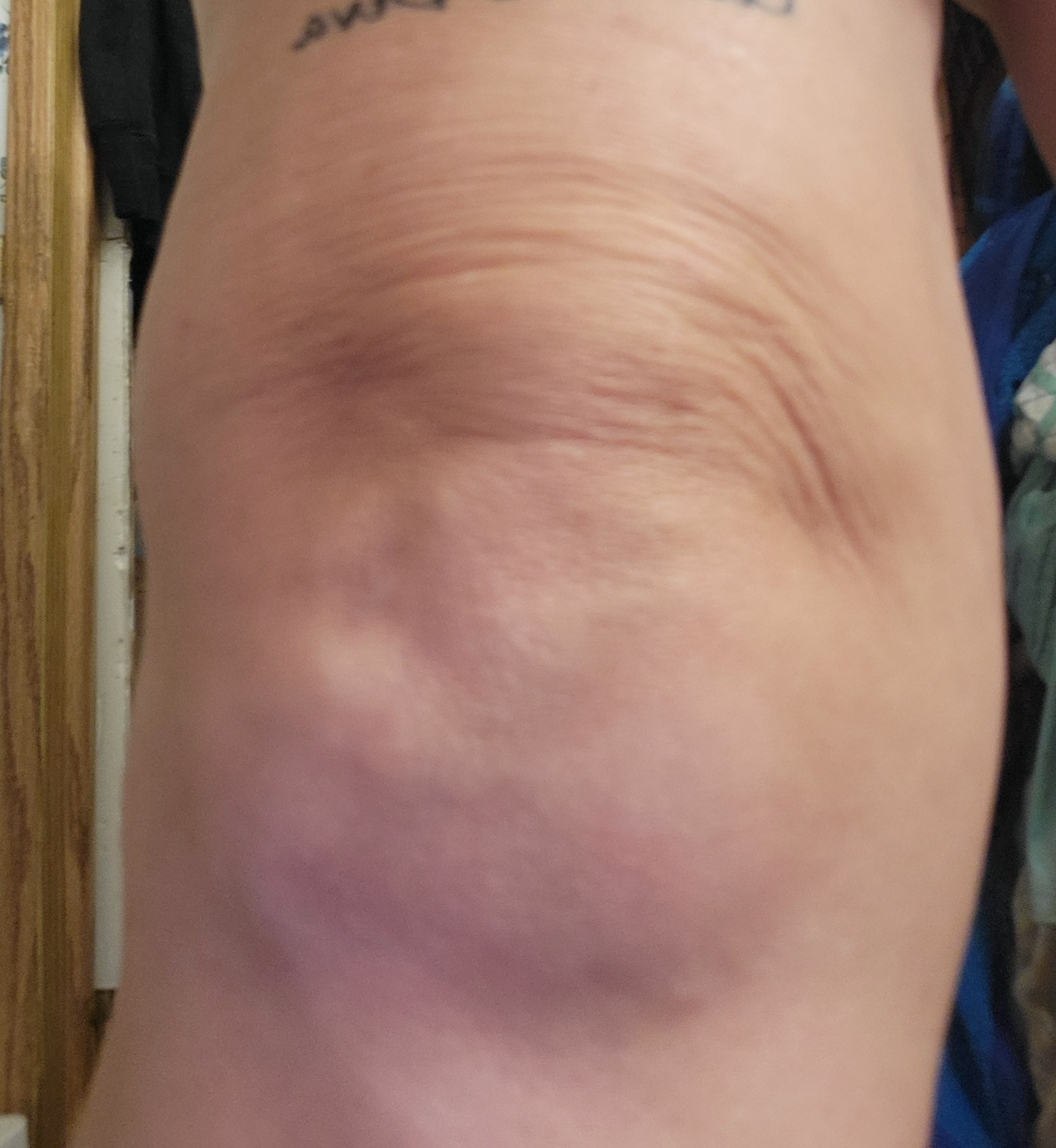 Fundraiser by Joann Strihafka : Support Joann’s Knee Replacement