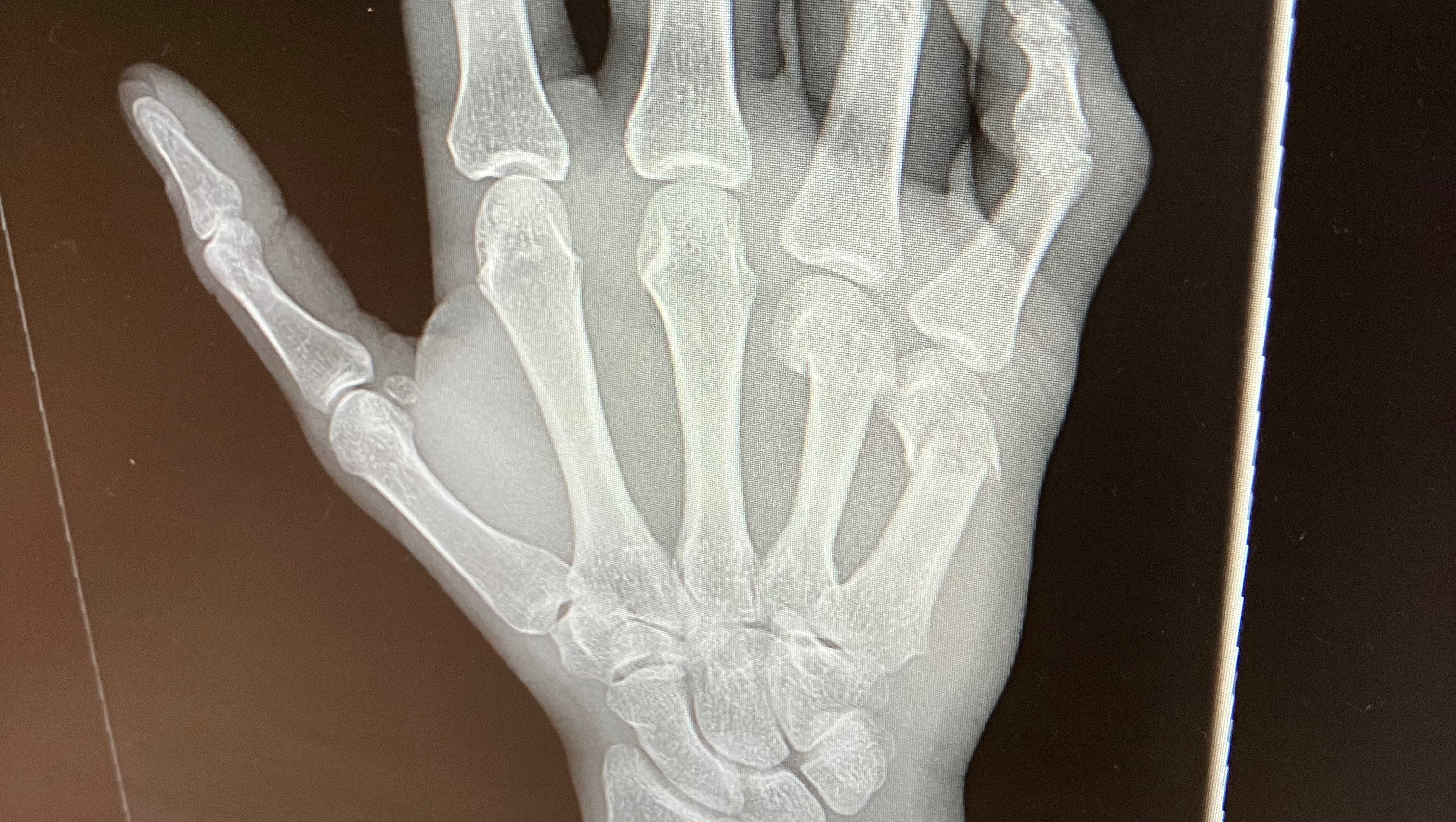 Fundraiser by Andrew Jacobs : Support Andrew’s Recovery After Hand Injury