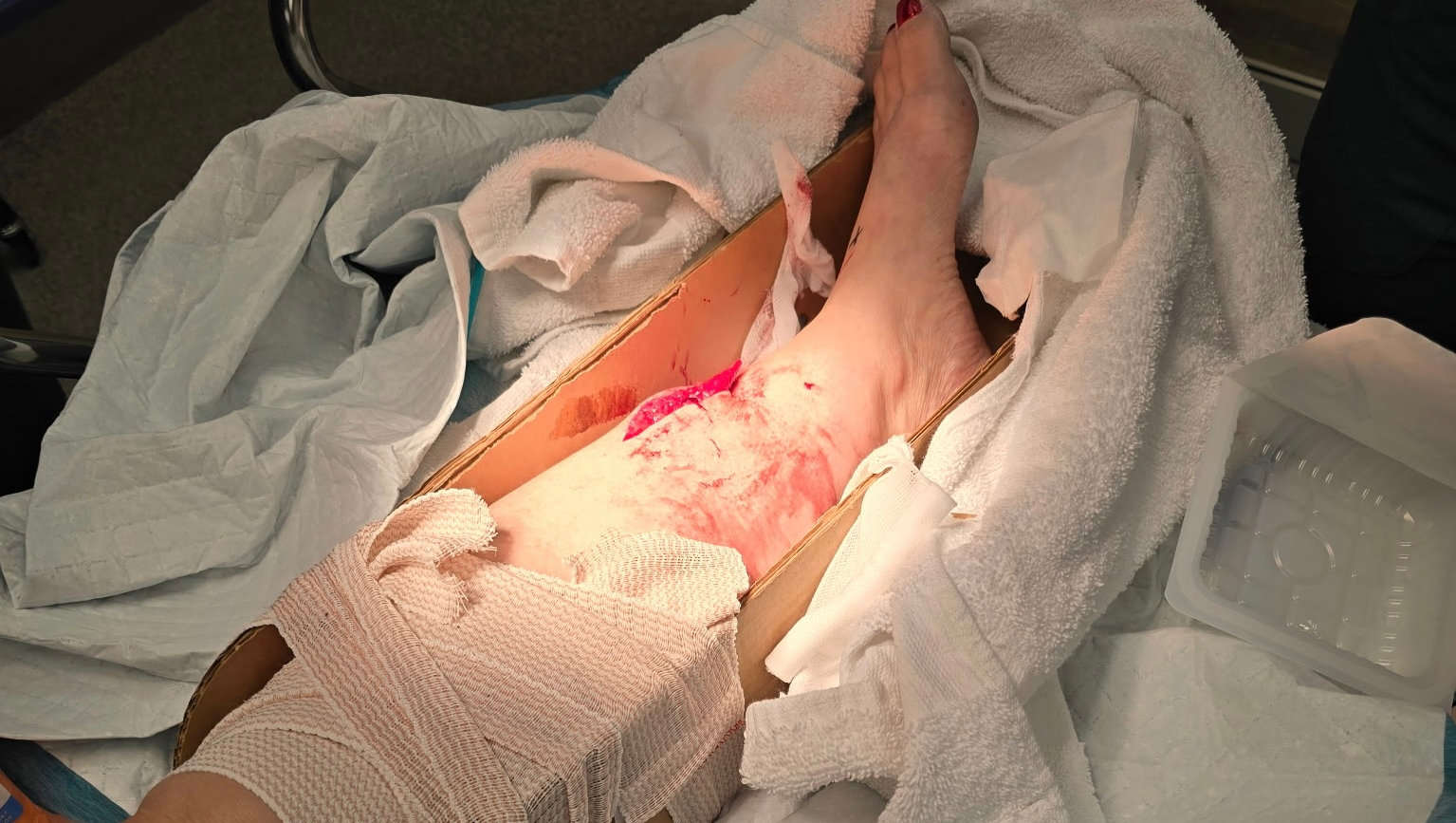 Fundraiser by Sharyn Taylor : Help With Medical Bills After falling off ...