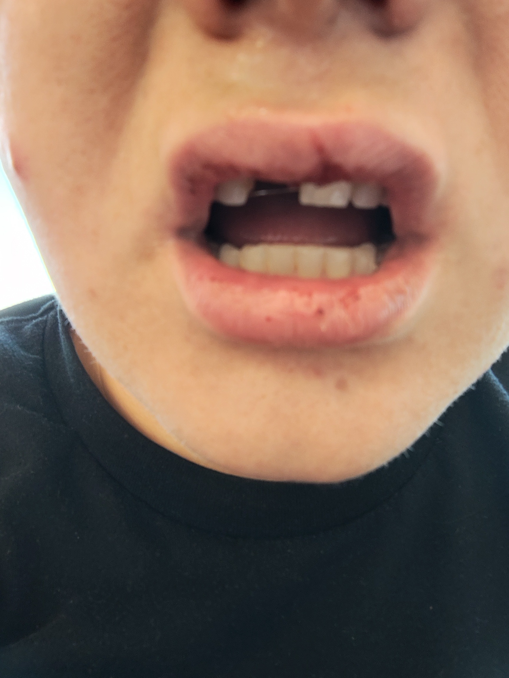 Fundraiser by Willow Ellison : Dental Care Support After Unfortunate ...