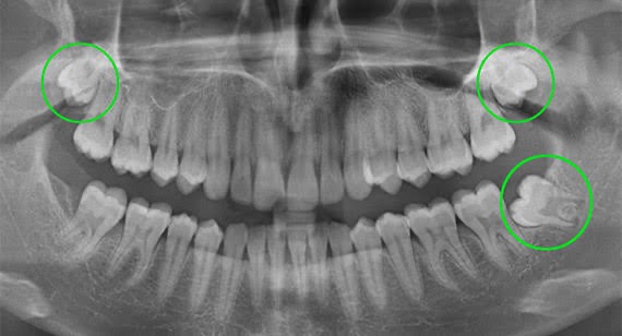 Fundraiser by Rory McKinnon : Fund my wisdom teeth removal and recovery!