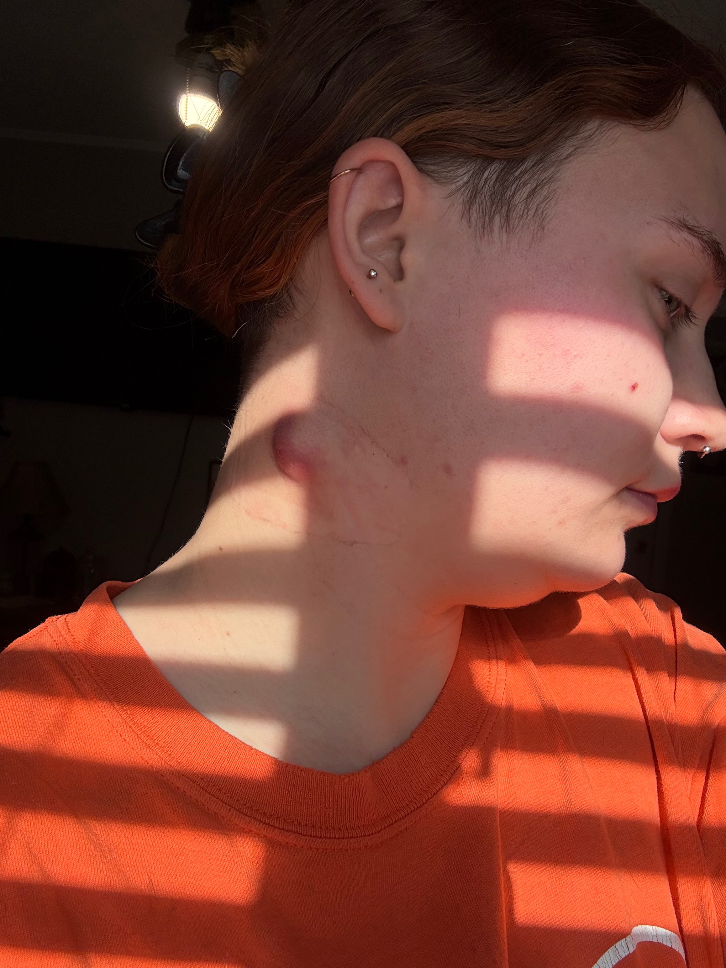 Fundraiser by Molly Capps : Help Molly Remove Painful Neck Lump