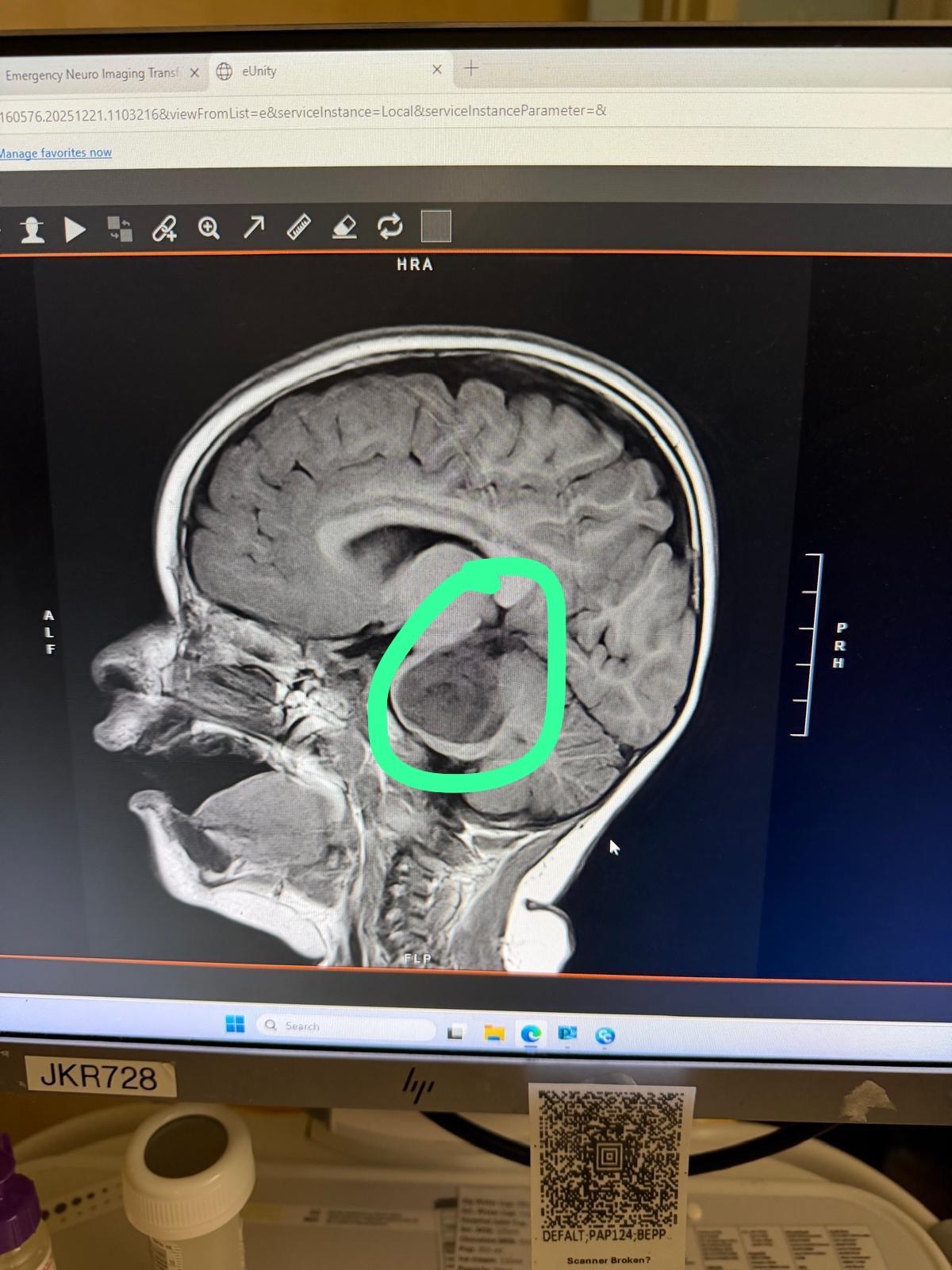 Fundraiser for Khalil Mosa by Molham Almoussa : Baby H.m cancer brain ...