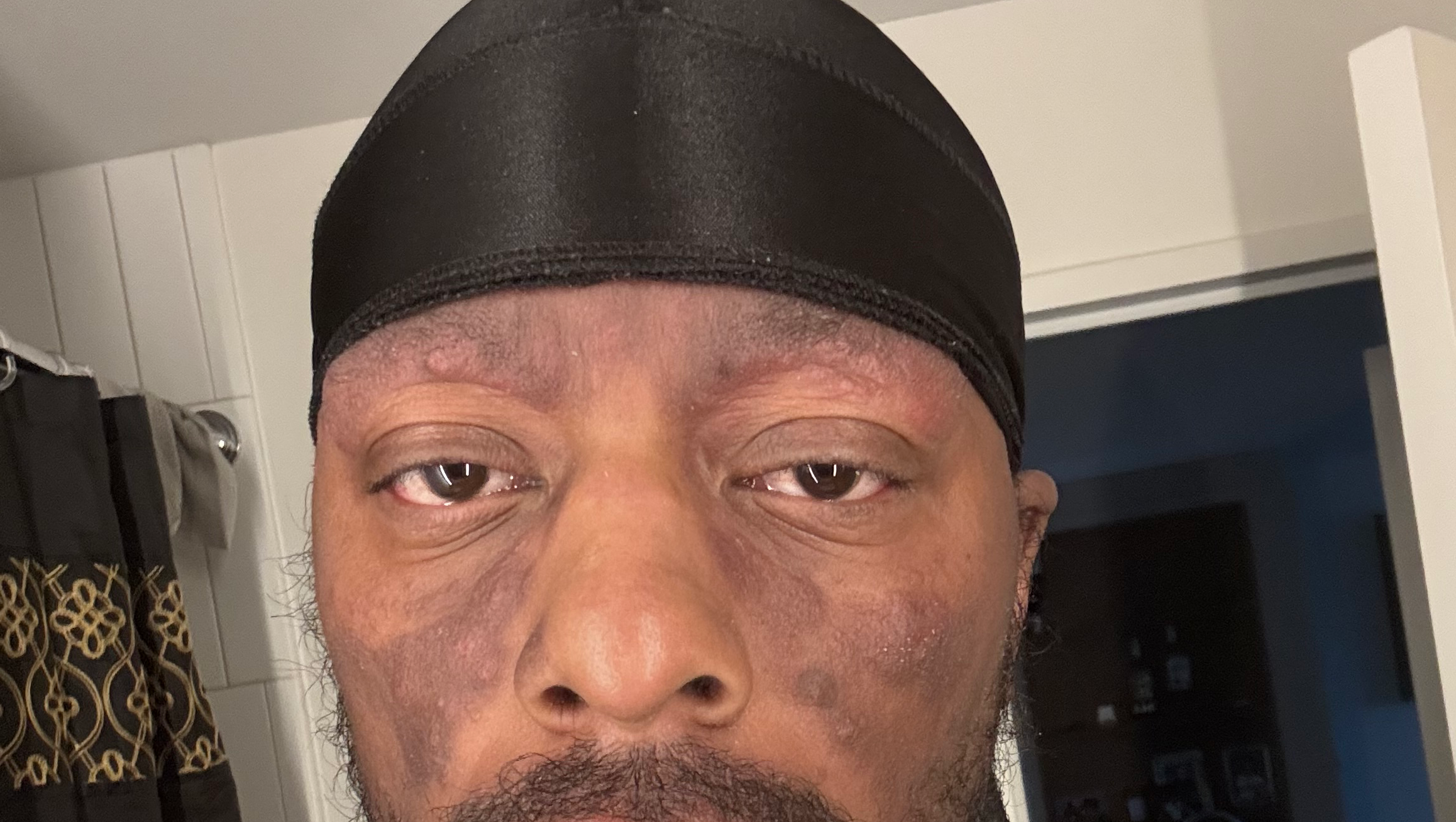 Fundraiser by Tre Adams : Support Tre Adams in His Fight Against Skin ...