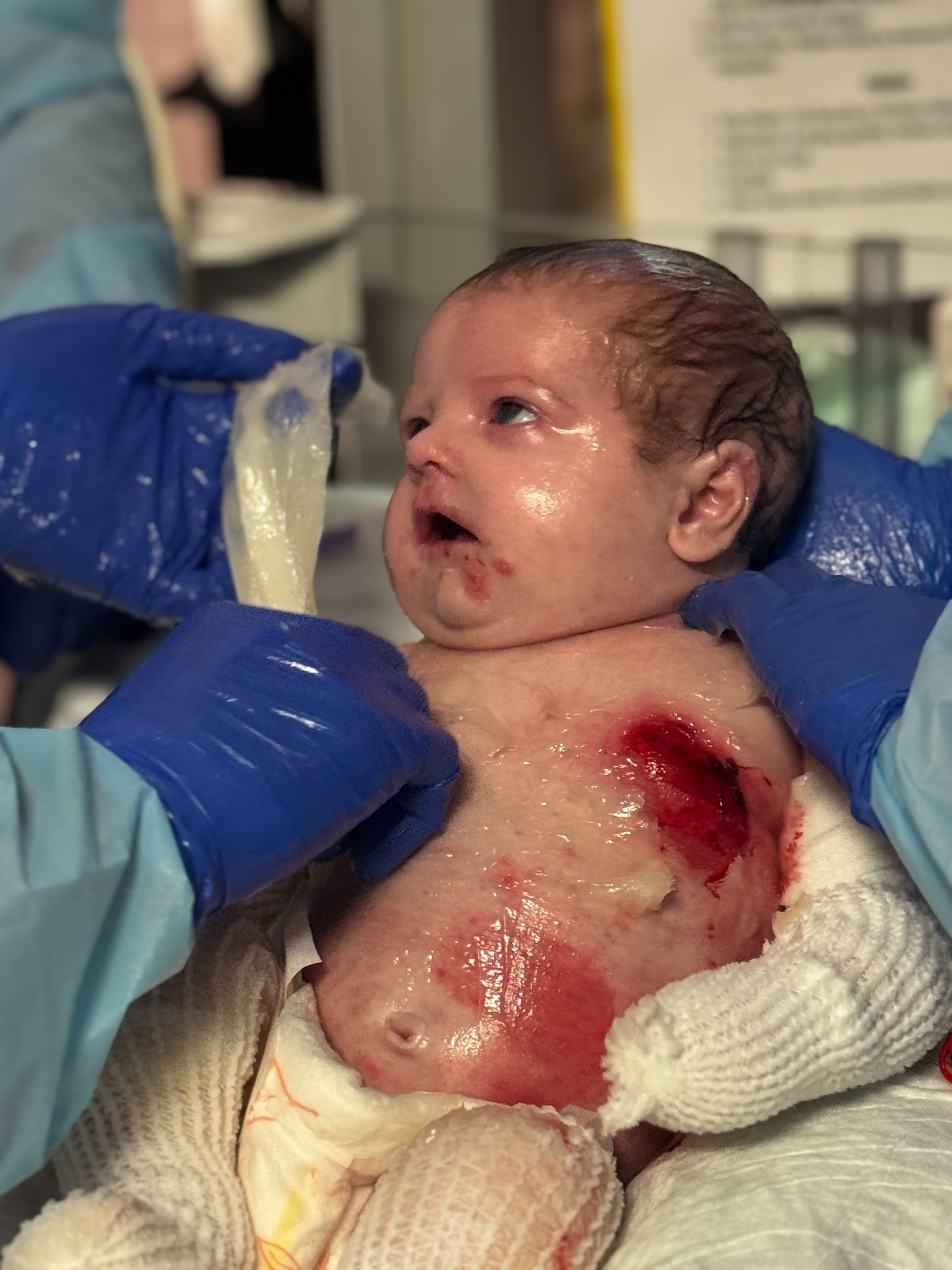 Fundraiser by Sebastiano Maiurro : Support Our Son's Fight Against EB ...